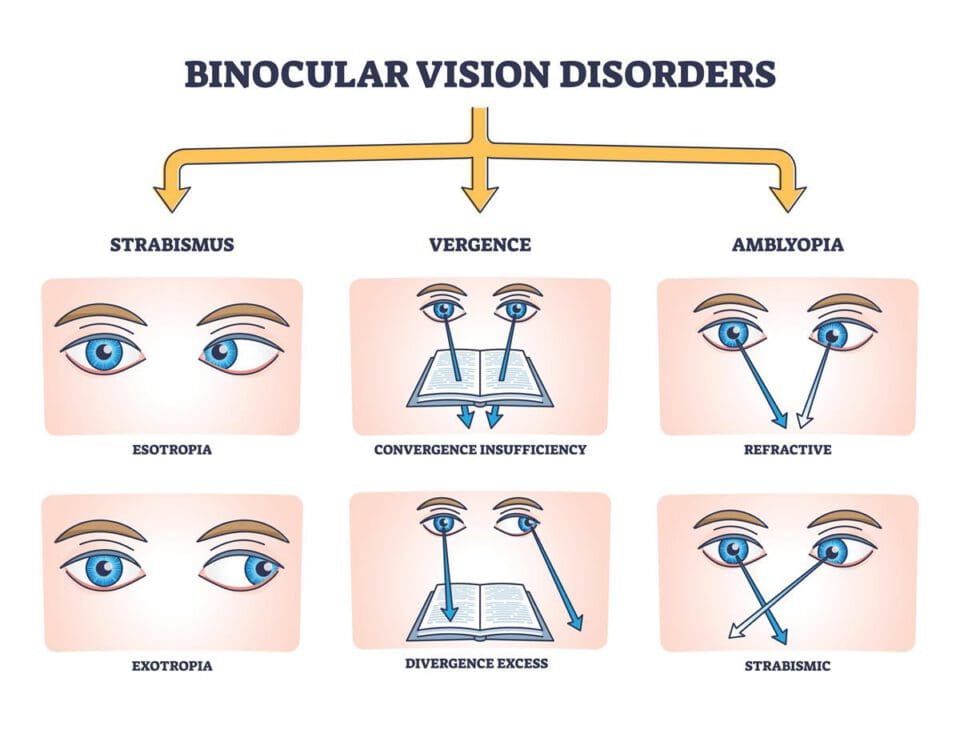 Convergence Insufficiency: Causes, Symptoms and Treatments Convergence Insufficiency: Causes, Symptoms and Treatments