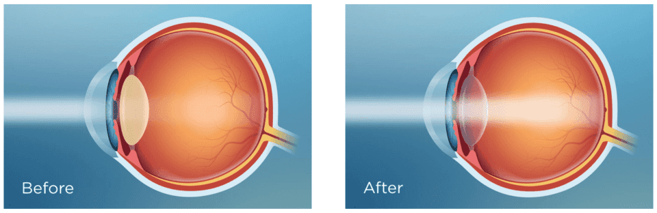 PanOptix Trifocal Lenses (IOL) for Cataract Surgery & RLE