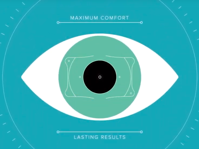 Implantable Collamer Lens (ICL) | NVISION Eye Centers