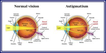 Types of Eye Surgery: An Exhaustive Guide – NVISION