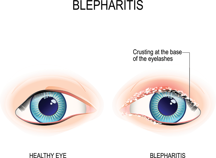 Swollen Eyelids Causes And How To Fix Them Fast Nvision