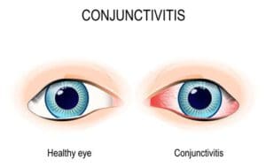Conjunctivitis (Pink Eye): Causes and Real Treatments