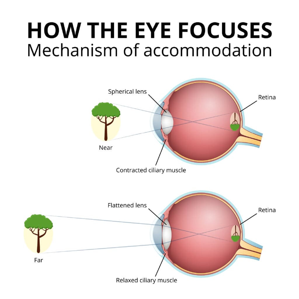 Guide to Accommodating IOLs for Cataract Surgery and RLE
