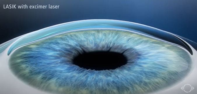 LASIK Eye Surgery | NVISION Eye Centers