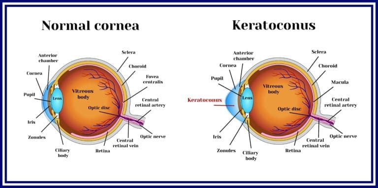 Keratoconus Lenses: What Are the Best Kinds in 2022? – NVISION
