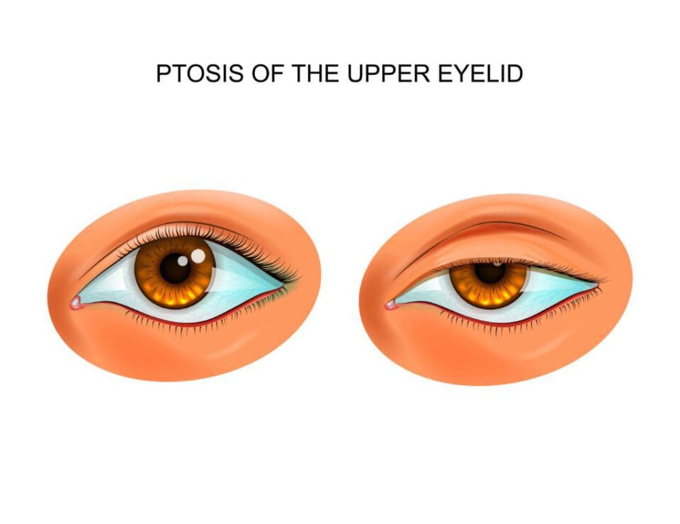 Ptosis Surgery: Costs, Recovery & More – NVISION
