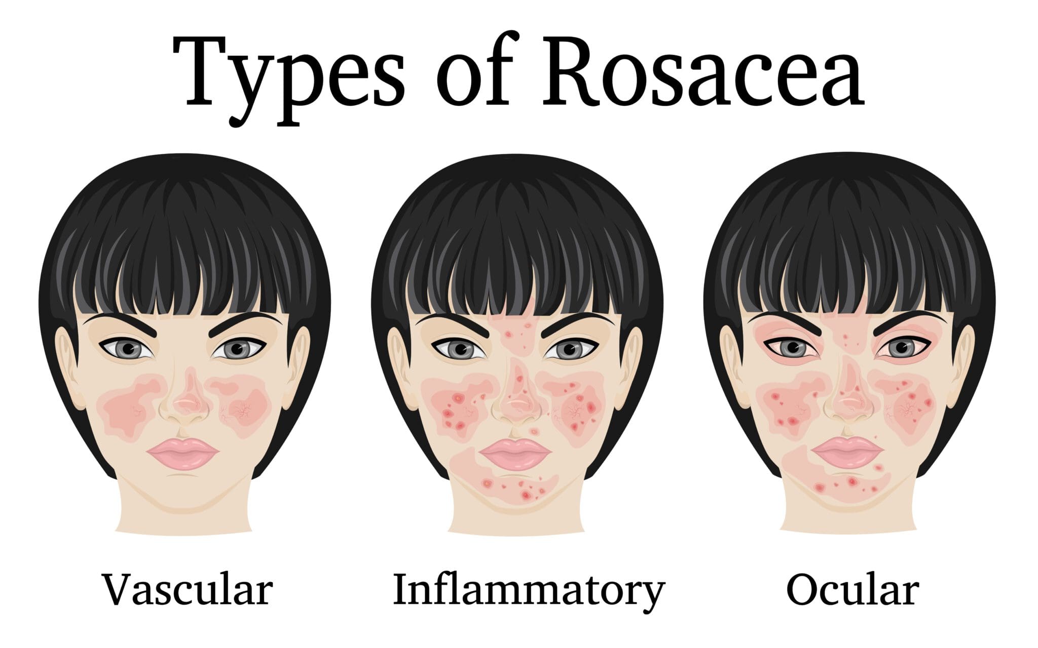 Guide to Ocular Rosacea: Treatment and More – NVISION
