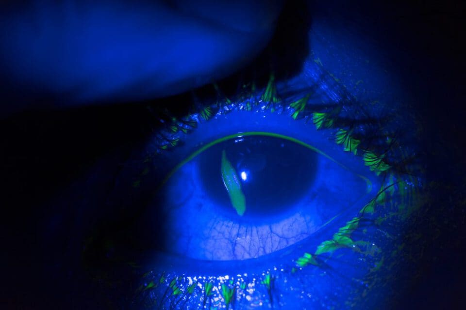 Corneal Abrasions: Signs, Causes and Treatment