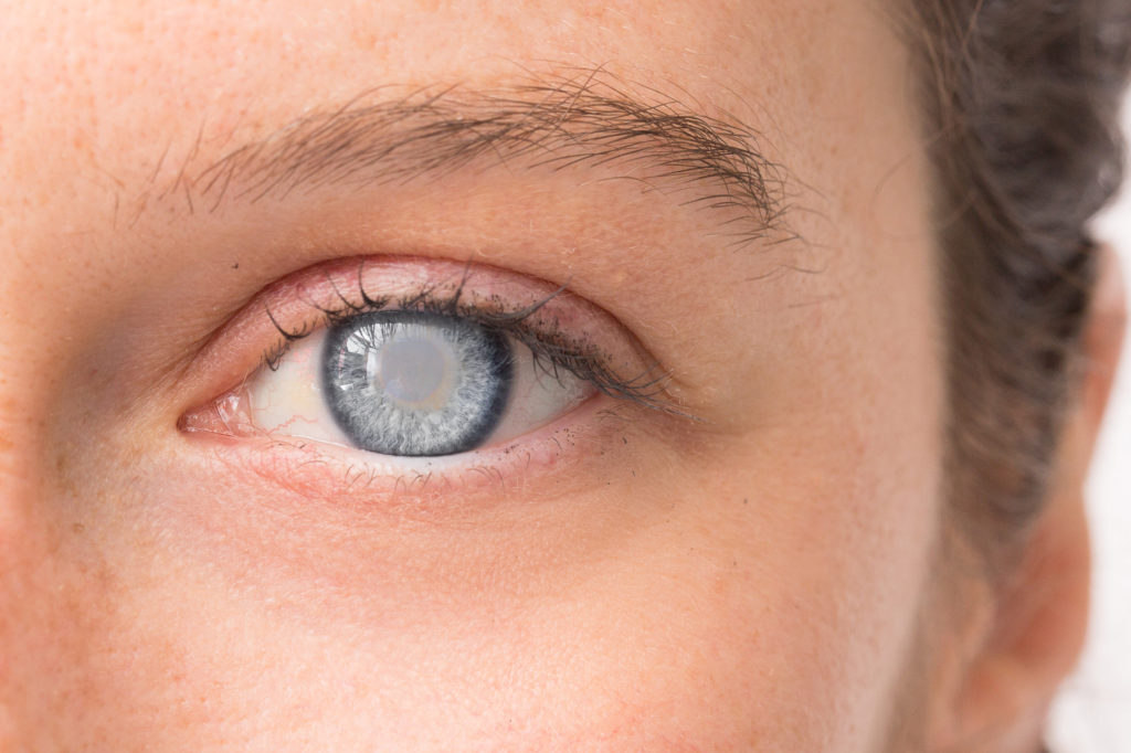Can You Cure Cataracts Naturally Without Surgery NVISION Eye Centers