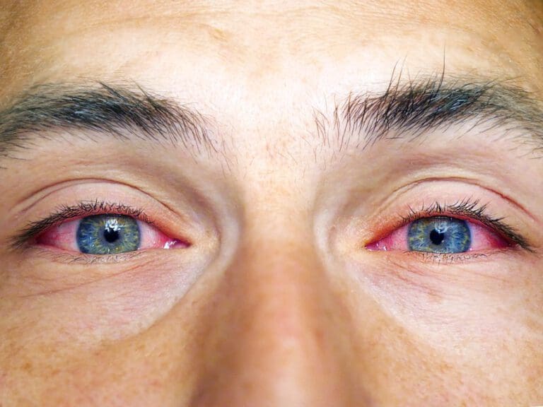 Visible Red or Blue Eye Veins: What To Do About Them? – NVISION