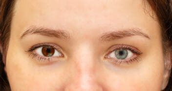 Heterochromia: When Does It Occur? (Types & Causes) – NVISION