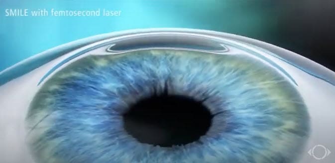 SMILE Eye Surgery - Schedule a Free Consultation