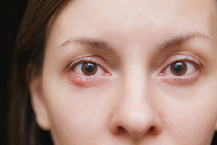 How to Get Rid of a Stye Quickly: At-Home Remedies & Medical Treatment