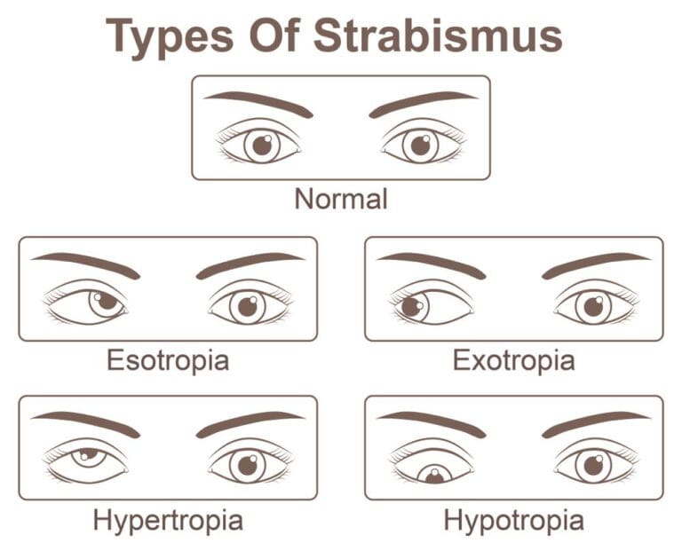 The Cost of Strabismus Surgery or Correction – NVISION