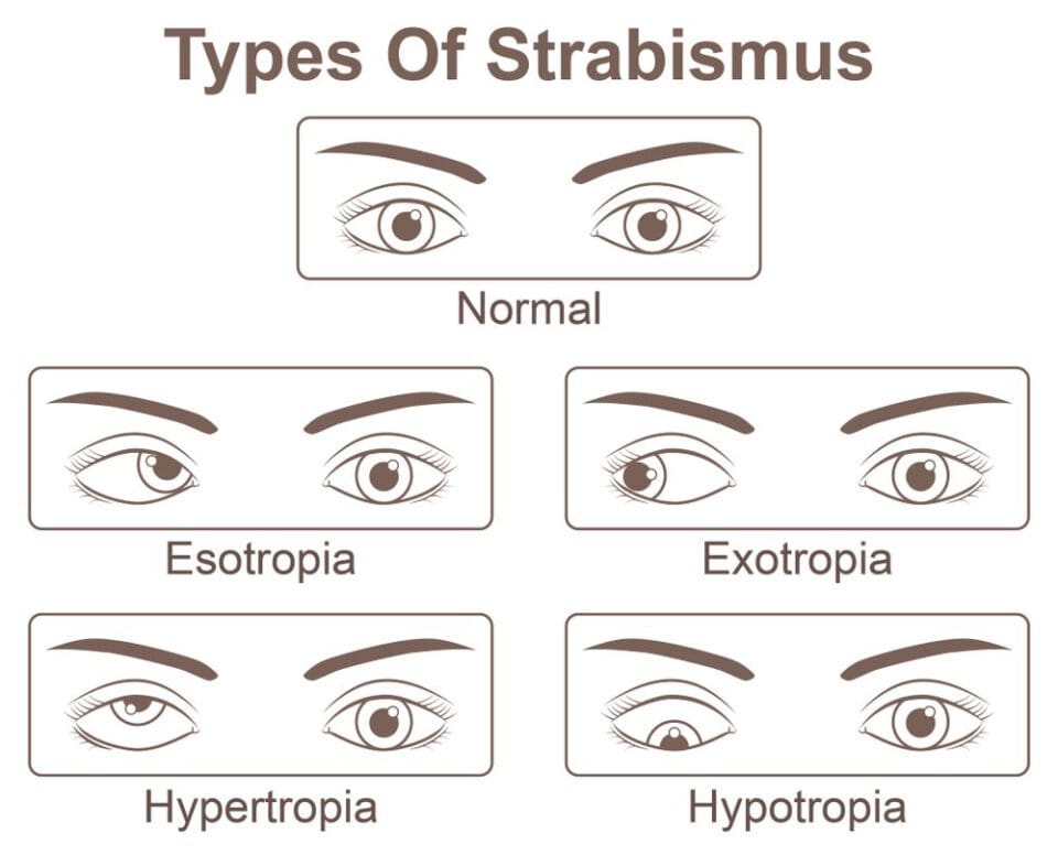 The Cost of Strabismus Surgery or Correction – NVISION
