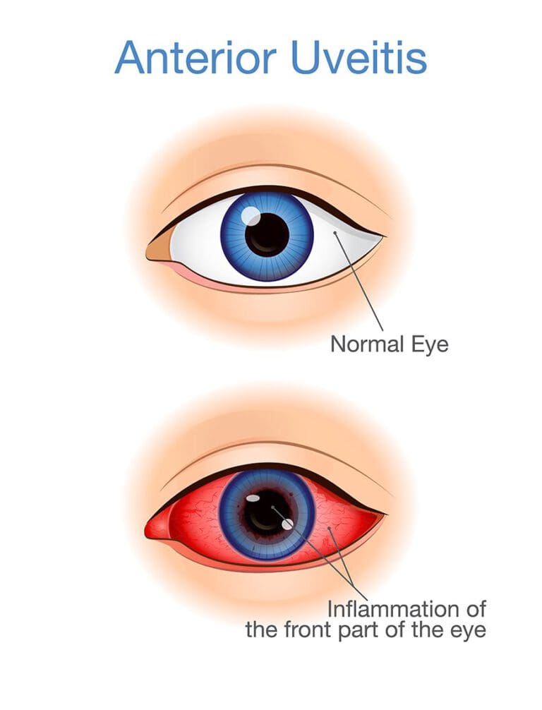 Uveitis: Symptoms, Causes and Treatment