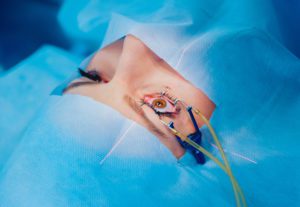 PRK Recovery Time, Tips & What to Expect | NVISION Eye Centers