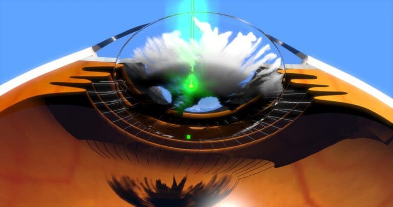 What Is YAG Laser Capsulotomy? | NVISION Eye Centers