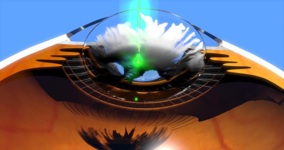 What Is YAG Laser Capsulotomy? | NVISION Eye Centers